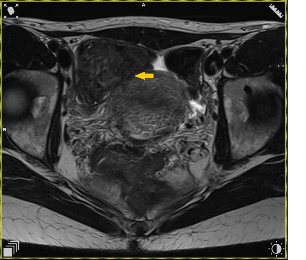 Pani Doktor mam endometriozę, czy mogę zajść w ciążę? - Quadia