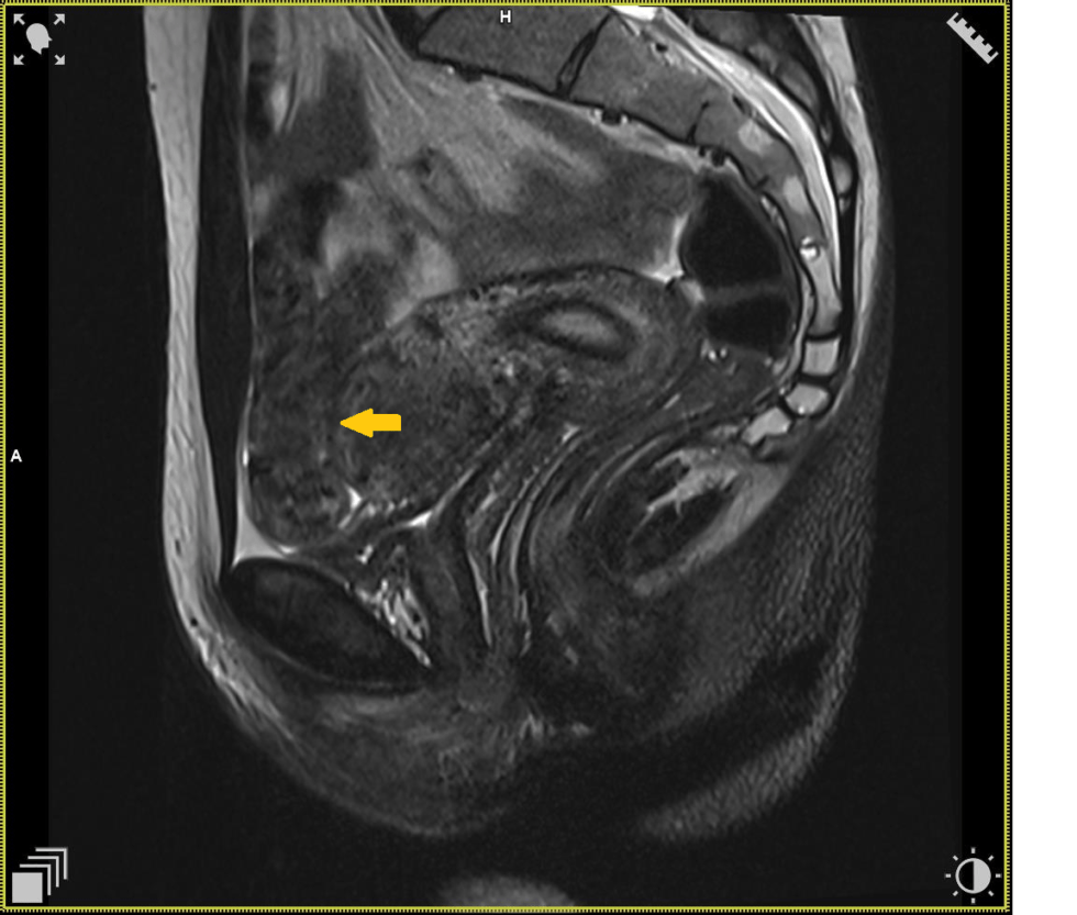 Pani Doktor mam endometriozę, czy mogę zajść w ciążę? - Quadia