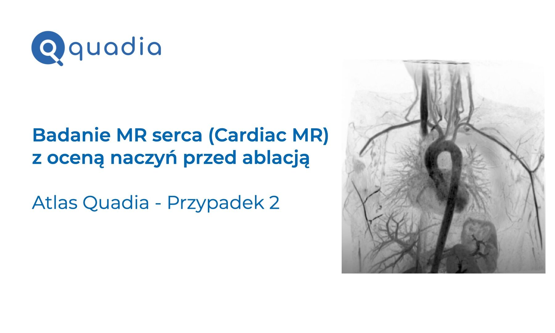 Przypadek 2 - Badanie MR serca (Cardiac MR) z oceną naczyń przed ...